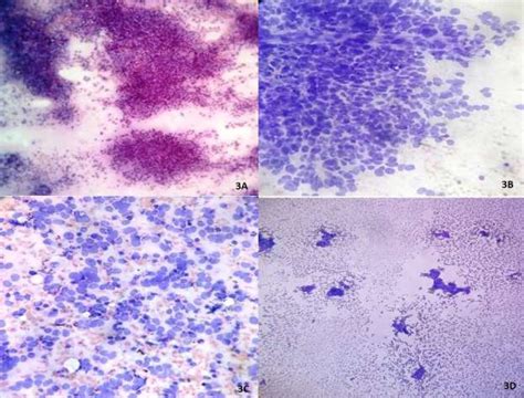 Photomicrograph Showing Low Power View Of Malignant Spindle Cells In A Download Scientific