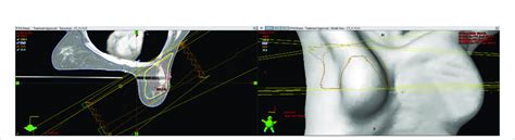 A Representation Of A Typical External Beam Accelerated Partial Breast Download Scientific
