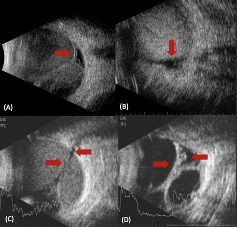 The “triangle” Sign A Novel Ultrasound Marker For Diagnosing Total