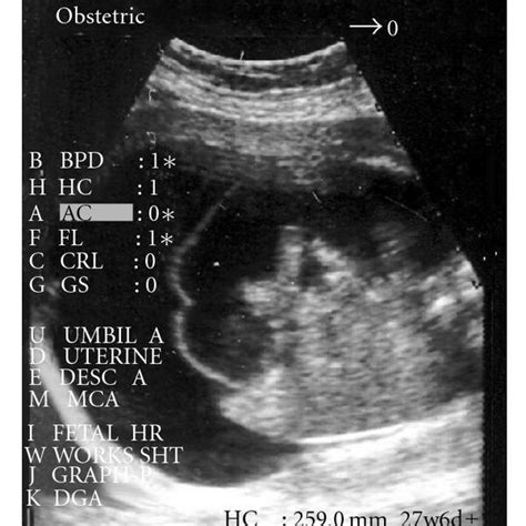 Voiding Cystogram Showing Ugs With Foley Catheter At The Confluence Of Download Scientific