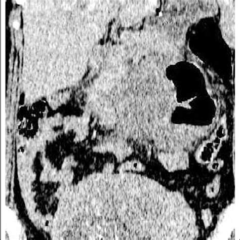 Sagittal Ct Image Of The Abdomen Shows Herniated Small Bowel With