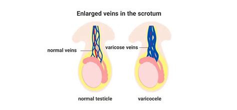 Understanding Varicocele Causes Effects On Male Fertility Diagnosis And Treatment