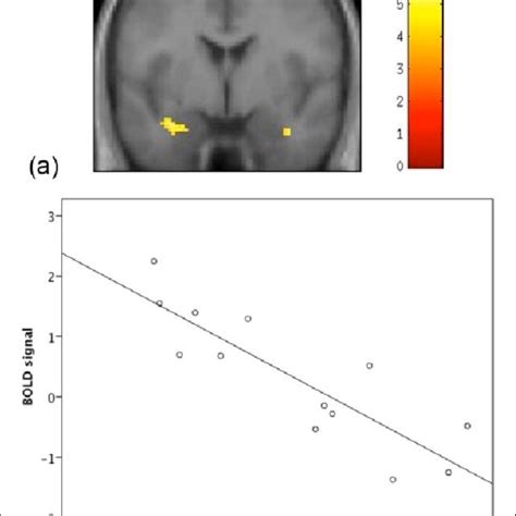A Statistical Parametric Map Showing A Negative Correlation Between