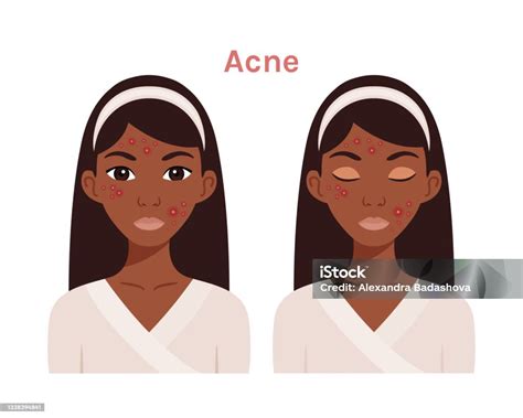 얼굴에 여드름을 가진 아프로 흑인 여자 문제 피부에 여드름 귀여운 여자의 초상화 얼굴 피부 트리트먼트 의료 의료 및 아름다움을위한 유행 일러스트 플랫 만화 스타일 벡터