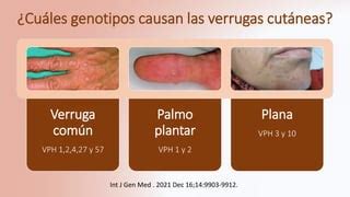 Infección Por El Virus Del Papiloma Humano Vph Verrugas Cutáneas Y