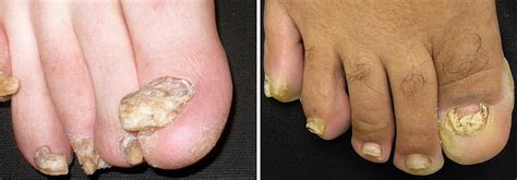 A Review Of The Clinical Phenotype Of 254 Patients With Genetically