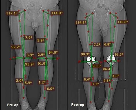 Pre And Post Operative Ct Scanogram Download Scientific Diagram