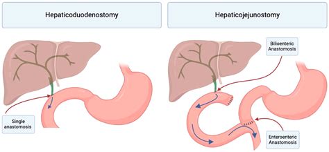Biliary Reconstruction With Hepaticoduodenostomy Versus Hepaticojejunostomy After Choledochal