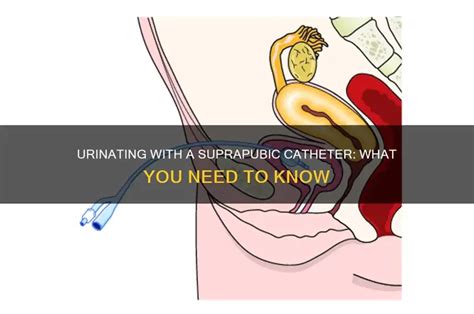 Urinating With A Suprapubic Catheter What You Need To Know Medshun