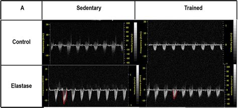 Echocardiographic Parameters Pulmonary Artery Doppler Flow Pattern C Download Scientific