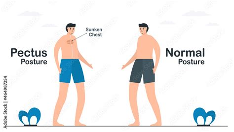 Comparison Of Normal And Pectus Posture Pectus Excavatum Has A Sunken