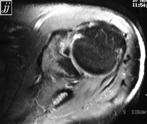 Sub Chondral Bone Defect Radiopaedia