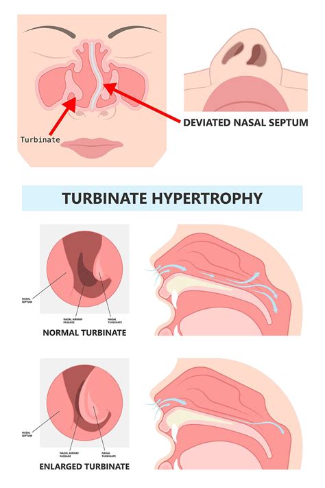 Improve Nasal Breathing With Septoplasty Morristown Nj