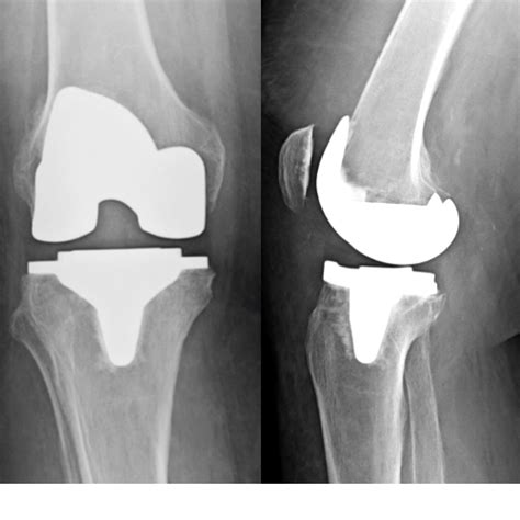 Implant Atlas — Hip And Knee Book