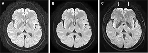 Clinical Impact Of Deep Learning Reconstruction In Mri Radiographics