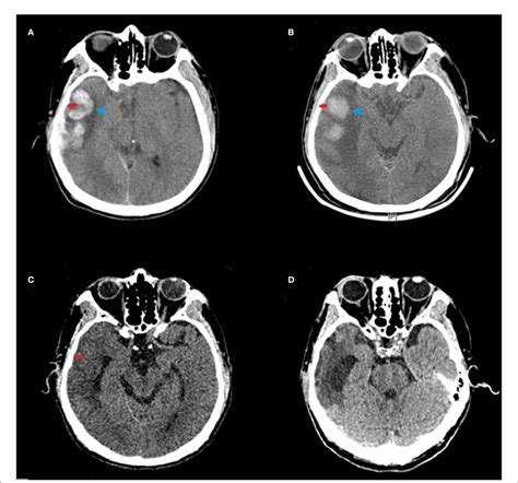 Figure Representative Ct Scans Of A Aa Year Old Male Patient With