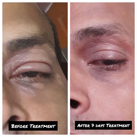 How To Cure Blepharitis Fast Know The Homeopathy Remedies