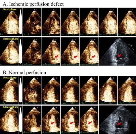 Adenosine Stress Echocardiography In Case Of Ischemic Perfusion