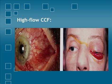 Ppt Differential Diagnosis Of Orbital Disease Powerpoint Presentation Id2224086 Ppt Differential Diagnosis Of Orbital Disease Powerpoint Presentation Id2224086