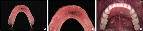 Conversion Of A Failing Fixed Implant Prosthesis Into An Implant