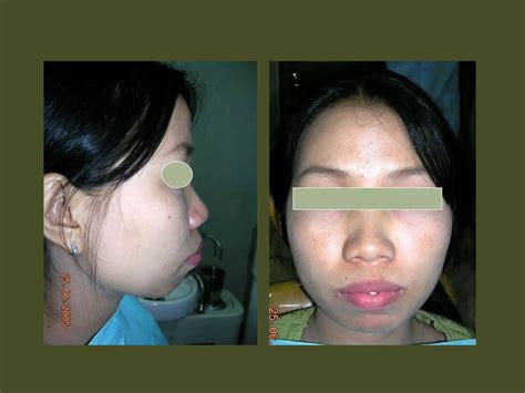 Class Ii Malocclusion Ppt Class Ii Malocclusion Ppt