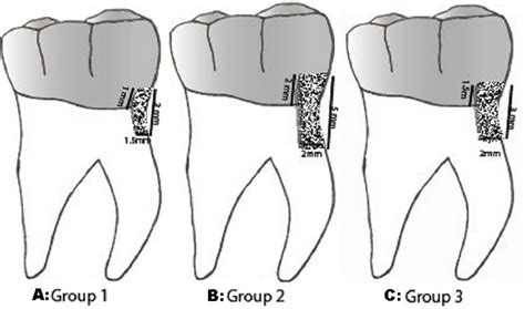 Comparison Of Microleakage Between Different Restorative Materials To Restore Marginal Gap At