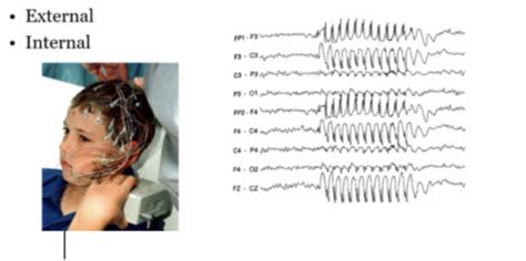 Aeiii Week 4 Key Points On Epilepsy And Seizure Disorders Flashcards