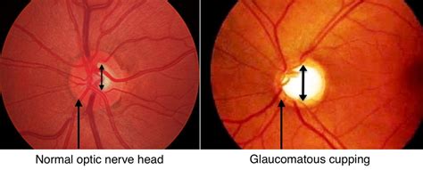 What Is Glaucoma Glaucoma Associates Of Texas