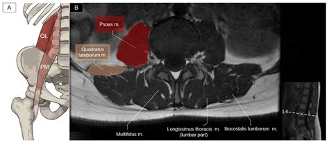 Pictorial Essay On Ultrasound And Magnetic Resonance Imaging Of