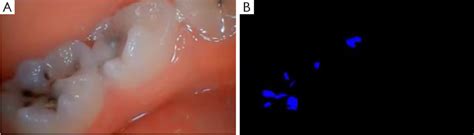 Figure 1 From A Deep Learning Model Using Convolutional Neural Networks For Caries Detection And