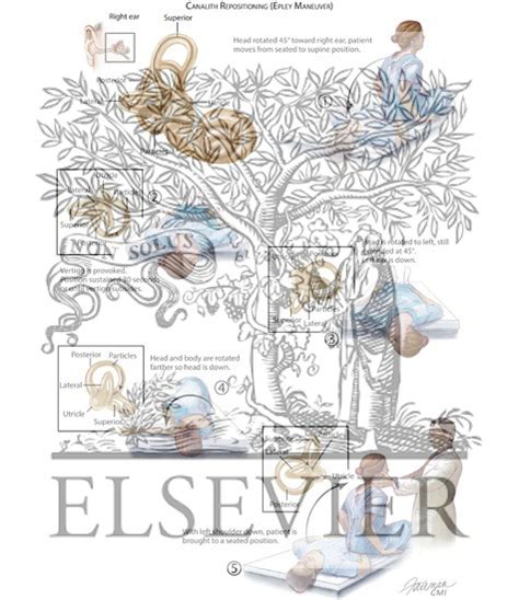 Canalith Repositioning Epley Maneuver