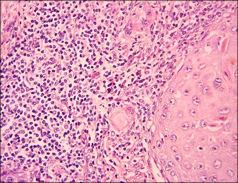 Oral Squamous Cell Carcinoma