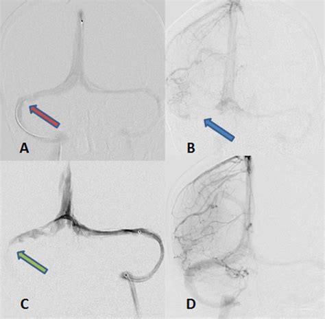Major Complications Of Dural Venous Sinus Stenting For Idiopathic