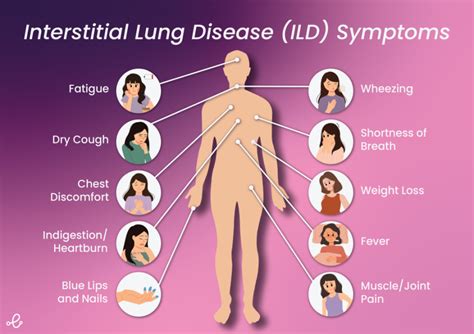 Exploring Treatment Options For Ild Cambridge Network