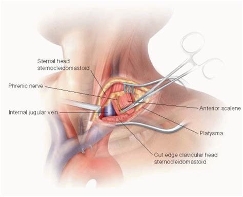 Extrathoracic Revascularization Carotid Carotid Carotid Subclavian Bypass And Transposition