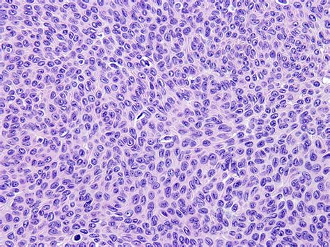 Pathology Outlines Poroma