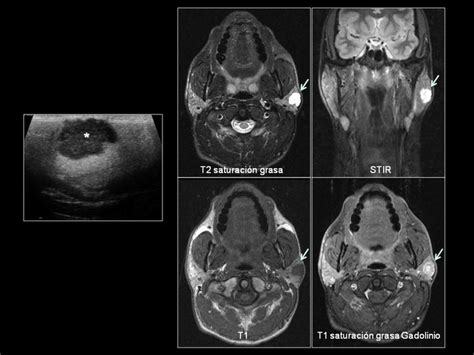 Pleomorphic Adenoma Us Shows A Hypoechogenic Nodule With Lobulated And