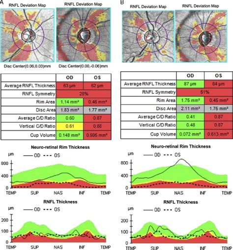 Optic Nerve Head And Retinal Nerve Fiber Layer Rnfl Scan Using Cirrus