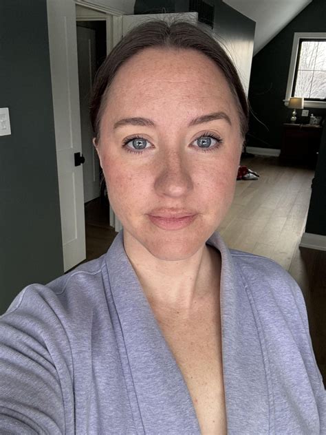 Hyperpigmentation Acne And Aging R30plusskincare