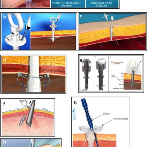 Representative Selection Of Laparoscopic Instruments And Closure