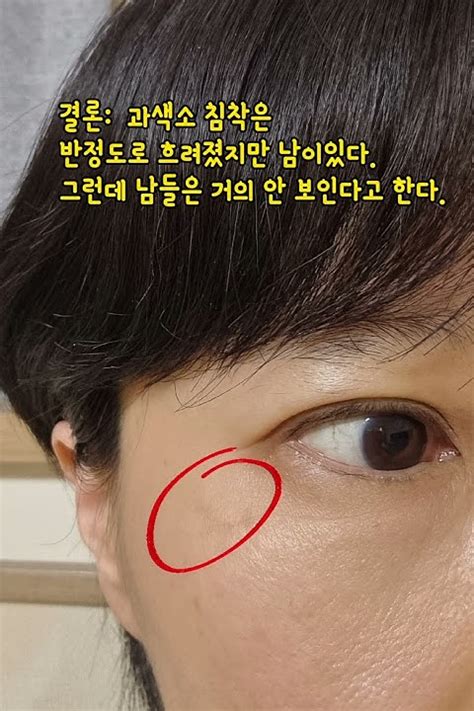 흑자제거 뒤 과색소침착 그 후 일년 Youtube