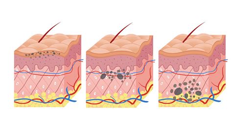 疤痕 挛缩疤痕 疤痕增生 色素型疤痕 凹陷性疤痕 浅表性疤痕 挛缩性疤痕 疤痕增生 疤痕疙瘩 缝合型疤痕 色素沉着 疤痕细胞横截面 祛疤痕 微创手术祛疤 疤痕疙瘩切除 抚平凹陷 无创疤痕修复