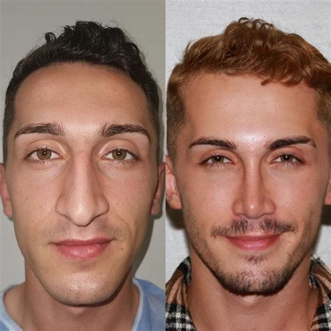 تغییرات باورنکردنی در چهره مردان؛ عمل‌ زیبایی فقط برای خانم‌ها نیست