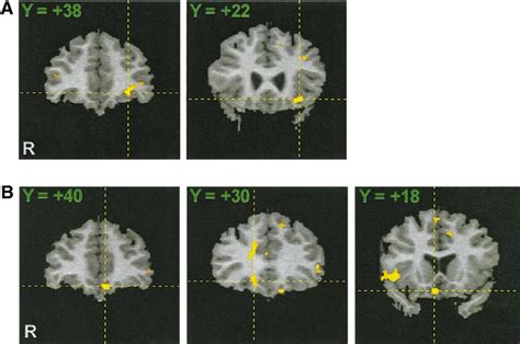 Coronal Slices Through Sections Of Orbitofrontal Cortex At The
