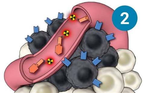 Psma Targeted Therapy For Prostate Cancer Ara Theranostics