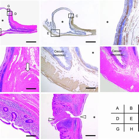Inverted Appendix Neuroma Figure 3 Inverted Appendix Before Biopsy Download Scientific Diagram