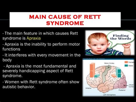 Retts Disease