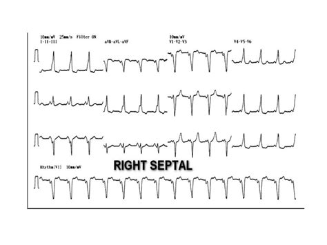 Localization Of Wpw Accessory Pathway By Surface Ecg