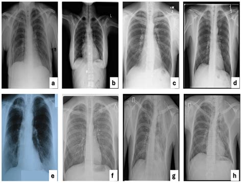X Ray Chest Tuberculosis European Group Offers Guidance For Treating