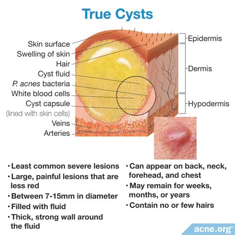 Cystic Acne Diagram Acne Diagram Vectors Download Free High Quality